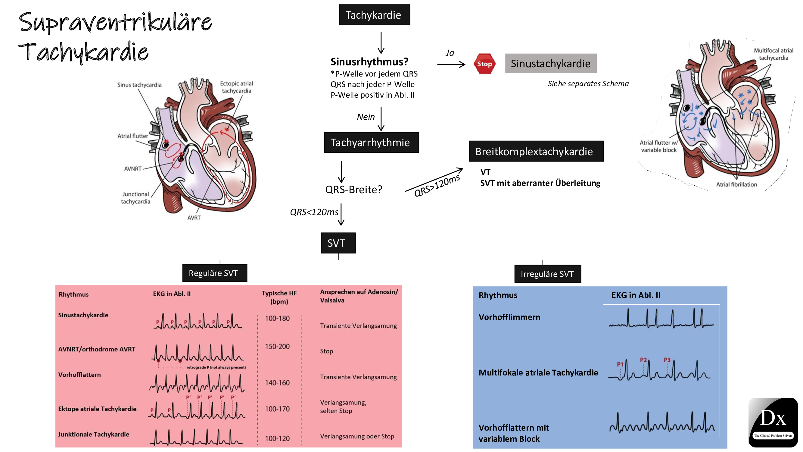 Supraventrikuläre Tachykardie – SVT – The Clinical Problem Solvers